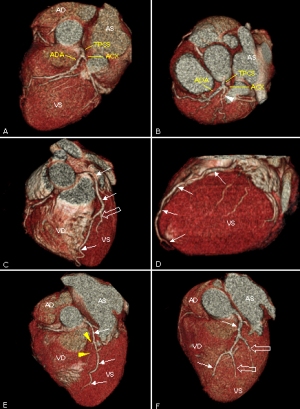 Figura 3 A-F. ANATOMIA NORMALE DELLE ARTERIE CORONARIE.